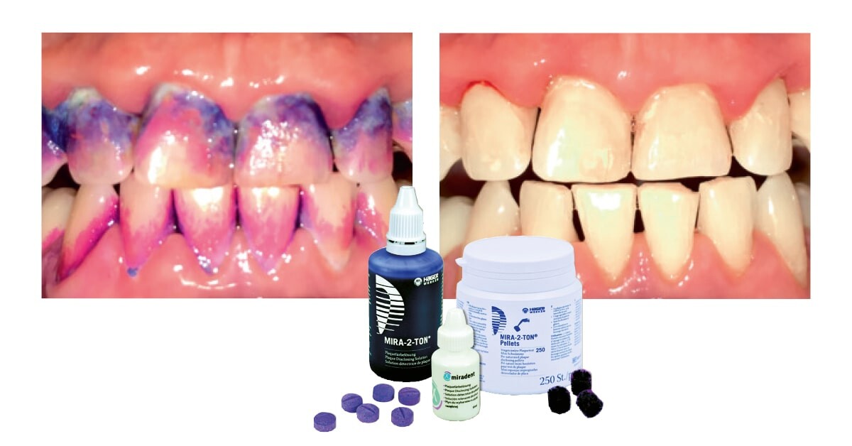 Mira-2-Ton: Dentalen Biofilm sichtbar machen | Al dente